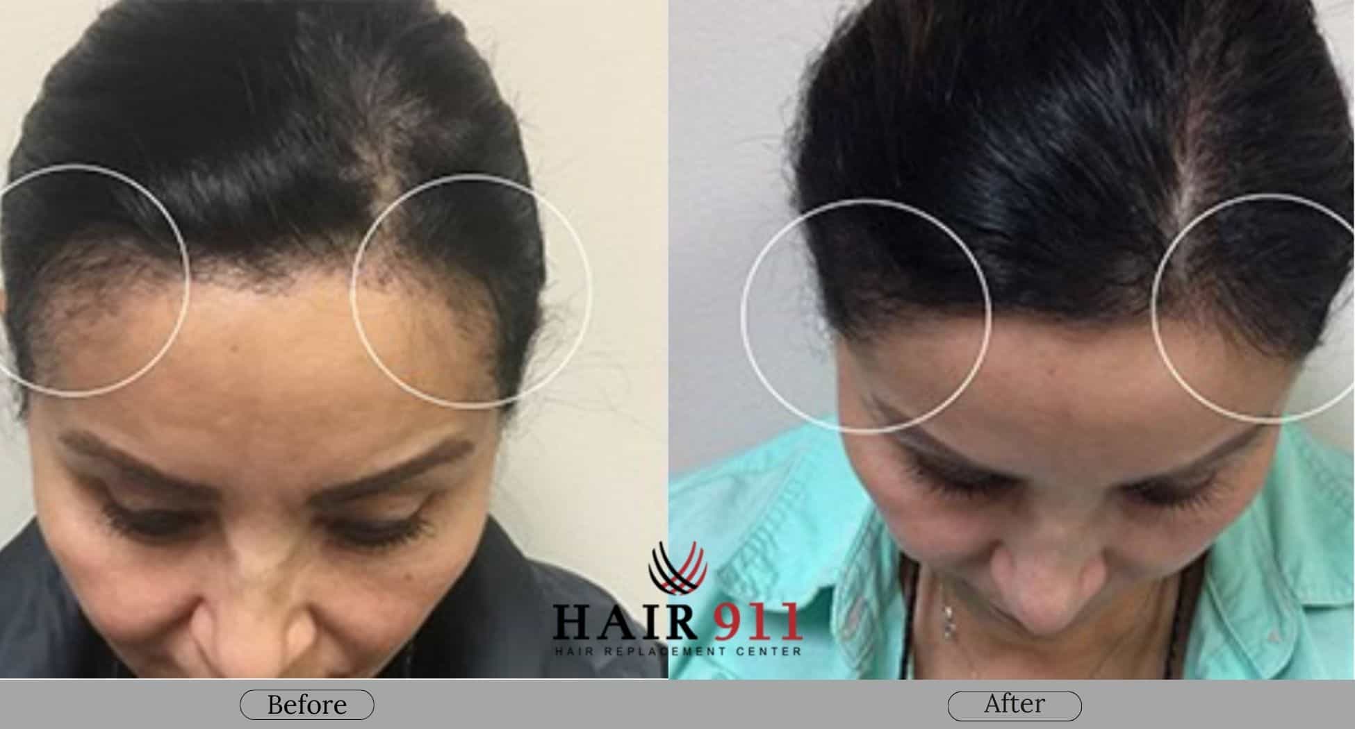 Female Hairline Restoration in Riverside | Hair911Pros – Stunning ...